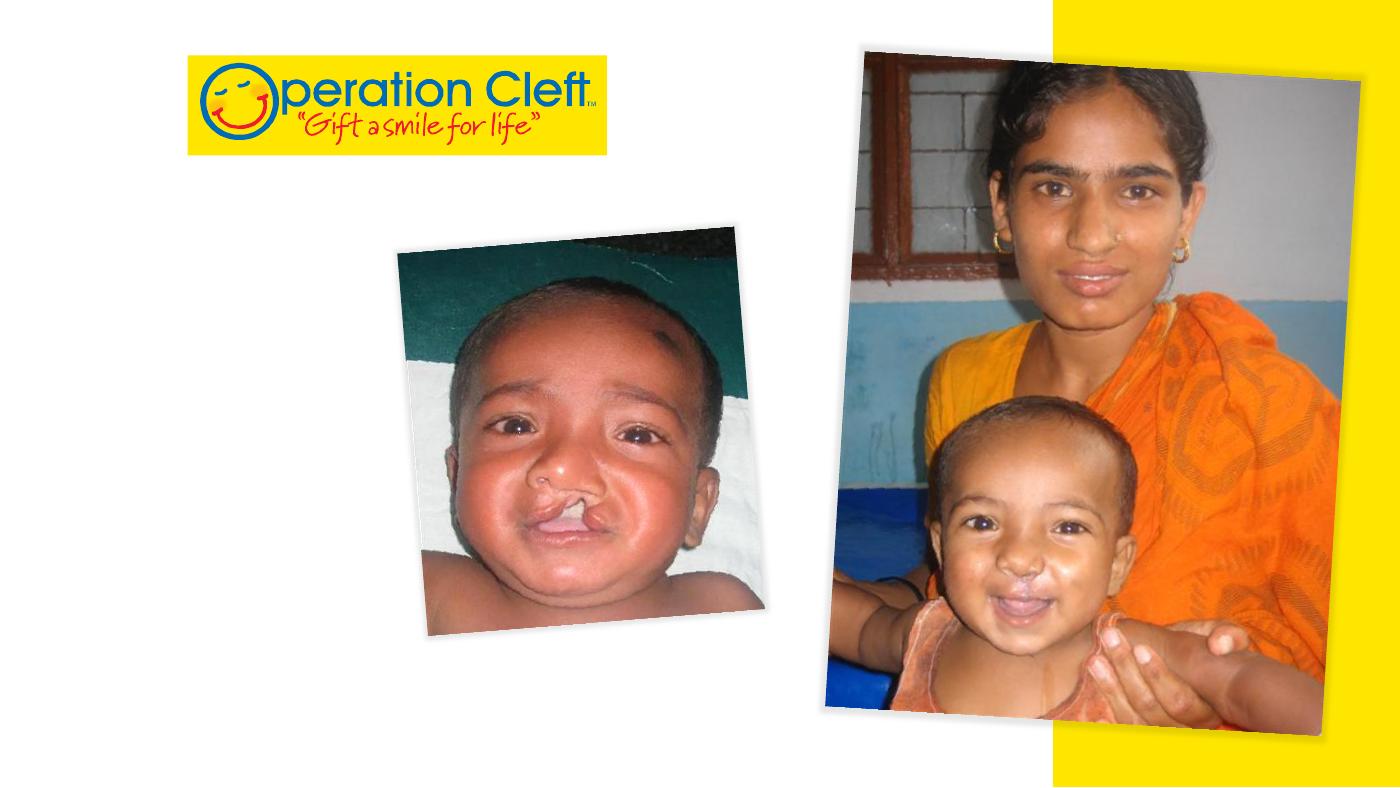 Operation Cleft Australia